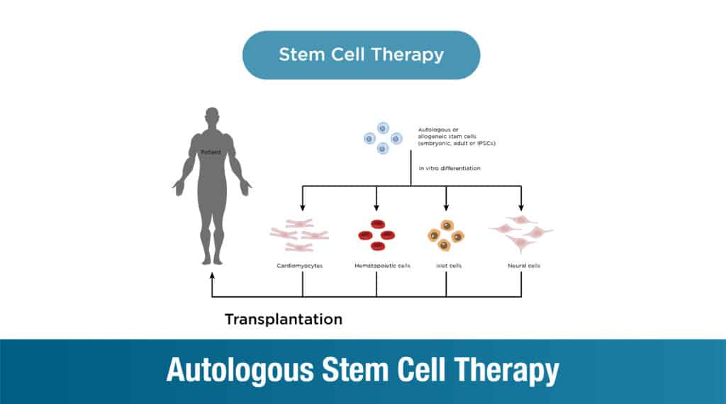 What is an autologous Cell transplant? - Plexus